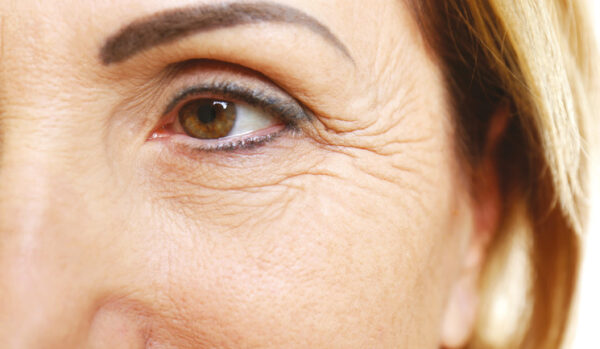 Special Feature: Treating Static Lateral Canthal Rhytids - Aesthetics ...