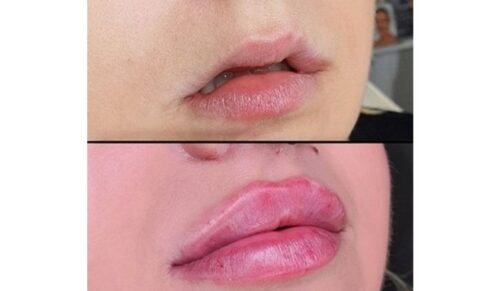Treating ‘M-Shaped’ Lips - Aesthetics Membership