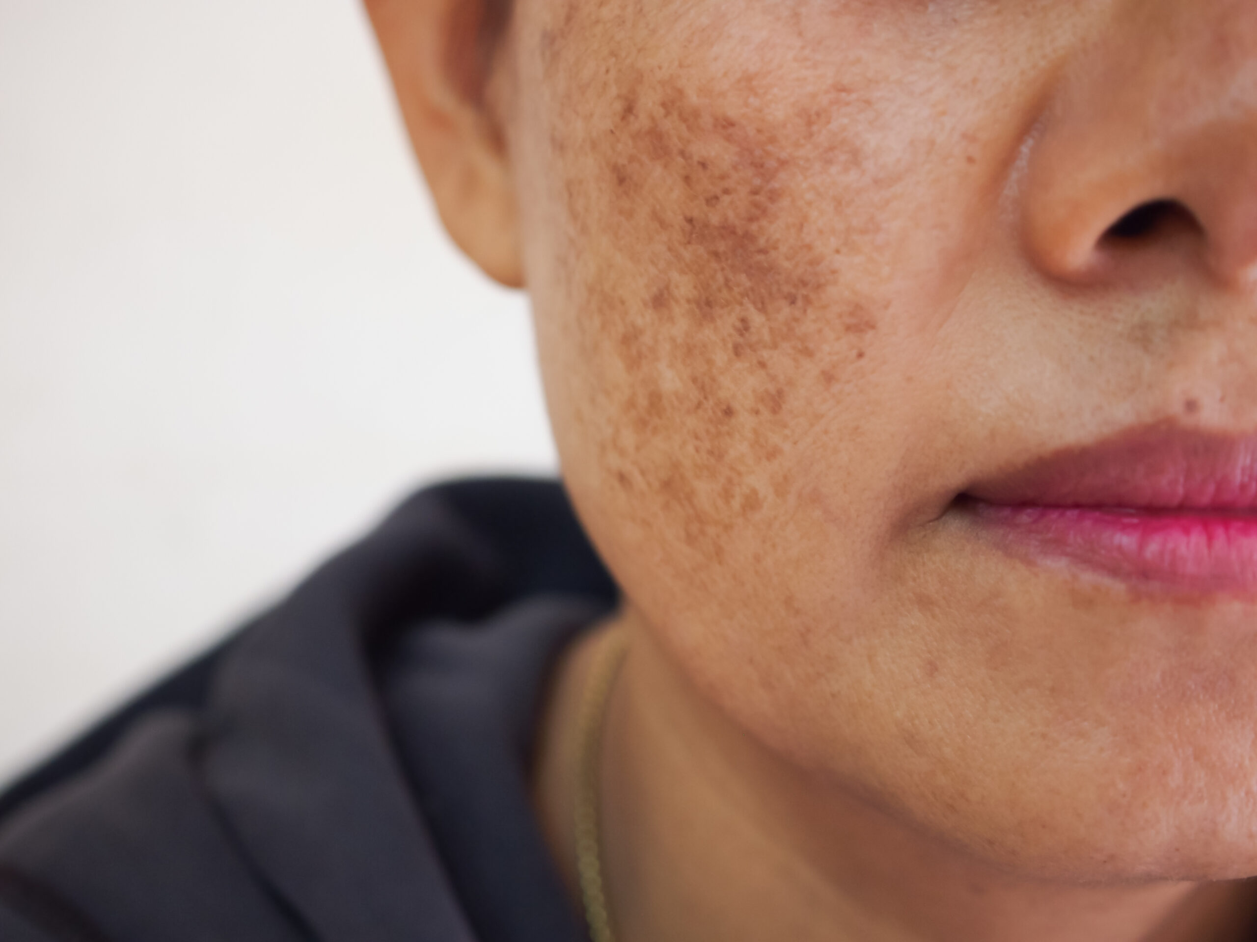 Understanding Dyspigmentation - Aesthetics Membership