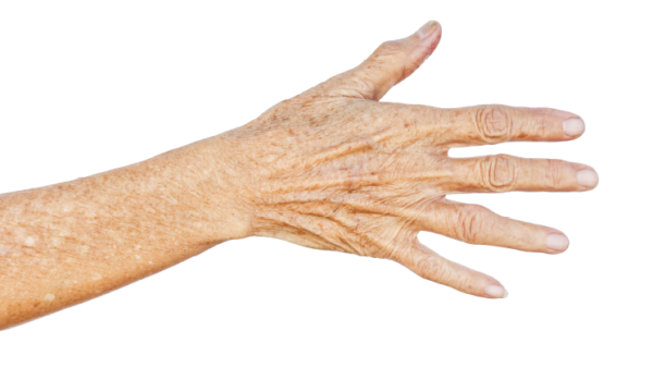 Case Study: Treating Upper Arm Skin Laxity - Aesthetics Membership